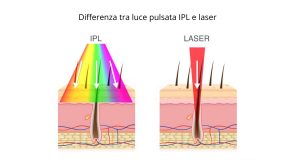 Come Funziona la Depilazione a Luce Pulsata - È sicura
